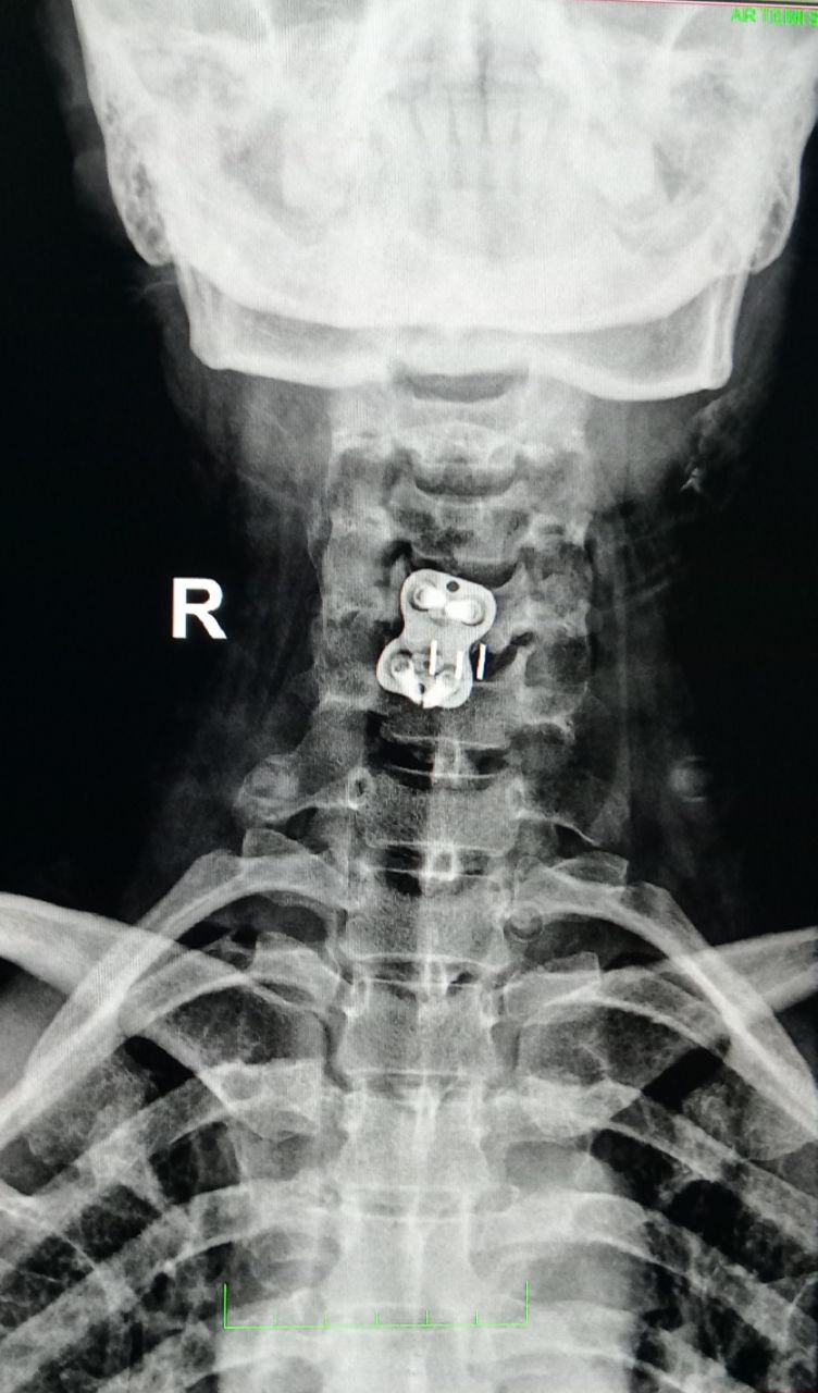 Successful ACDF Surgery in India for Patient from Republic of Iraq