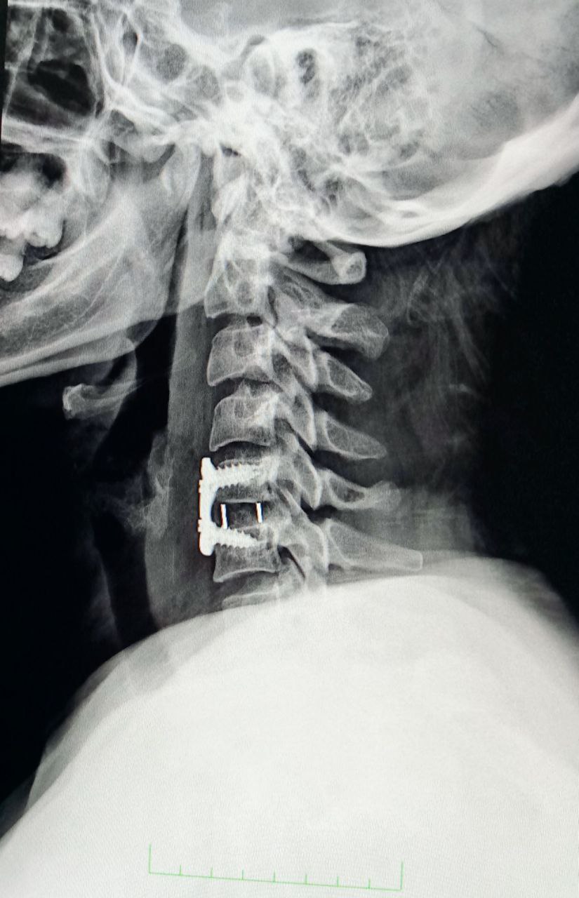 Successful ACDF Surgery in India for Patient from Republic of Iraq