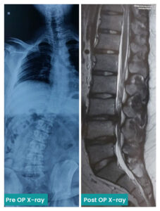 Microdiscectomy (Microdecompression) Spine Surgery - Case Study of 26 ...
