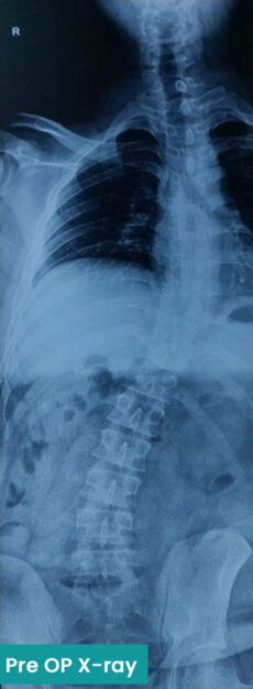 Microdiscectomy (Microdecompression) Spine Surgery - Case Study of 26 ...