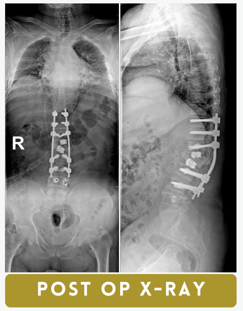 Spinal Fixation Surgery in India | Spinal Fixation without Fusion