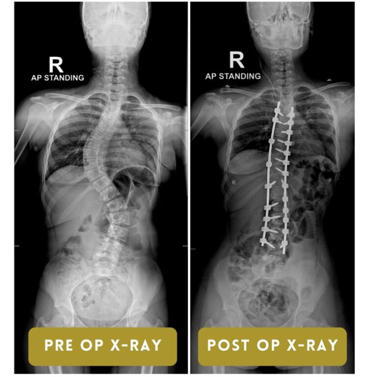 A Young Girl's Triumph Over Scoliosis - SPINE & SCOLIOSIS SURGERY IN ...
